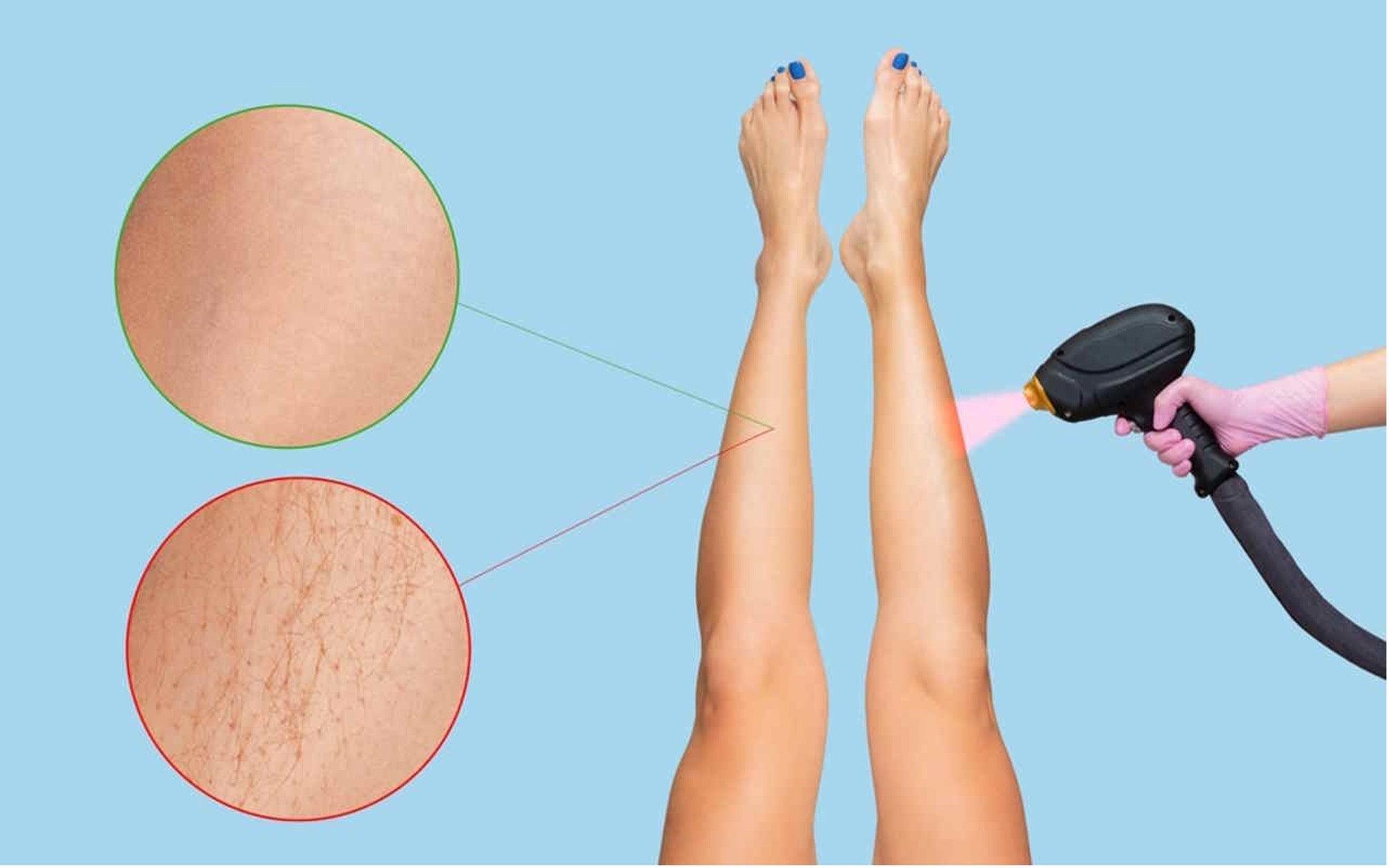 Épilation laser : peut-on se fier aux résultats avant/après ? – SSSKIN